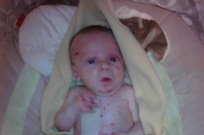 Help for Eli - a sweet baby battling Epidermolysis Bullosa | Indiegogo