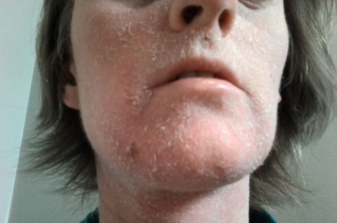 Red Skin Syndrome | Indiegogo