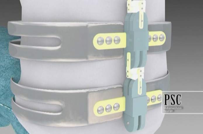 Spinal Cord Protection | Indiegogo