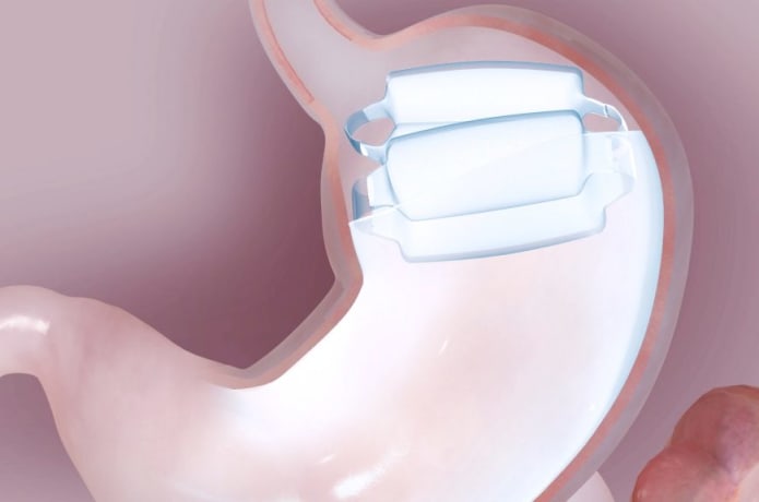 IG Balloon - Swallowable Weight Loss Device | Indiegogo